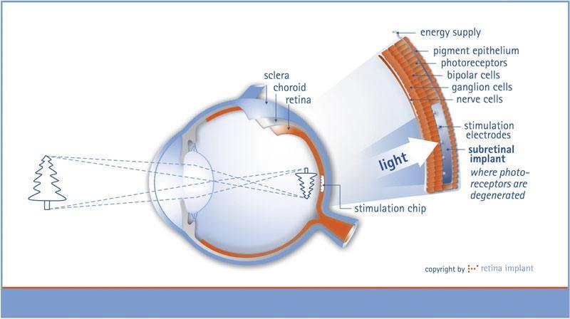 Latest Bionic Eye Developments Indicate Bright Future for Ocular ...