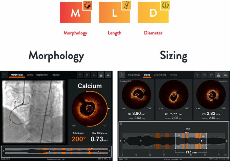 Abbott Launches New AI-Powered Coronary Imaging Platform in Europe