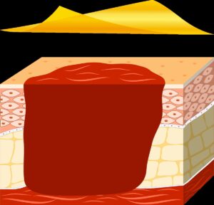 Imbed Raises $10M for FDA-Cleared Wound Care Technology