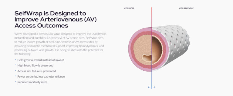 VenoStent Secures $20M for Novel Dialysis Access Solution